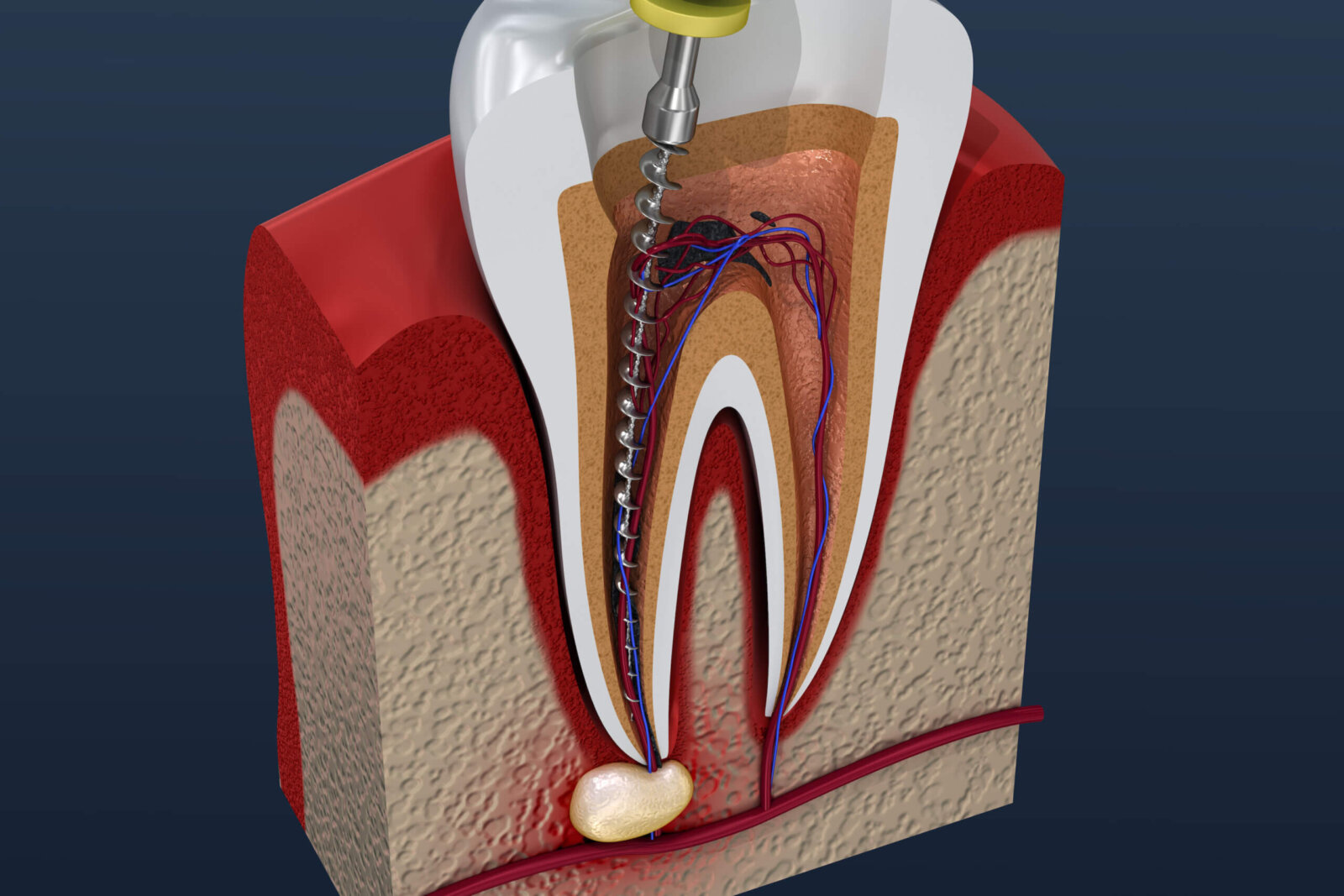 Root Canal Treatment Process 3D Illustration Hancock Village Dental
